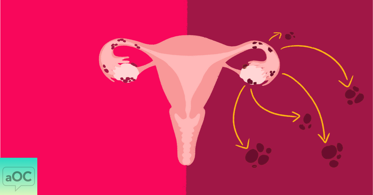 What Is The Difference Between Early And Advanced Ovarian Cancer?